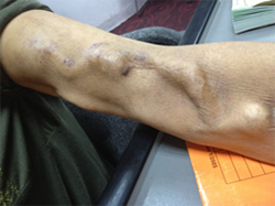 Surgery for AV Fistula: The Lifeline of a Haemodialysis Patient