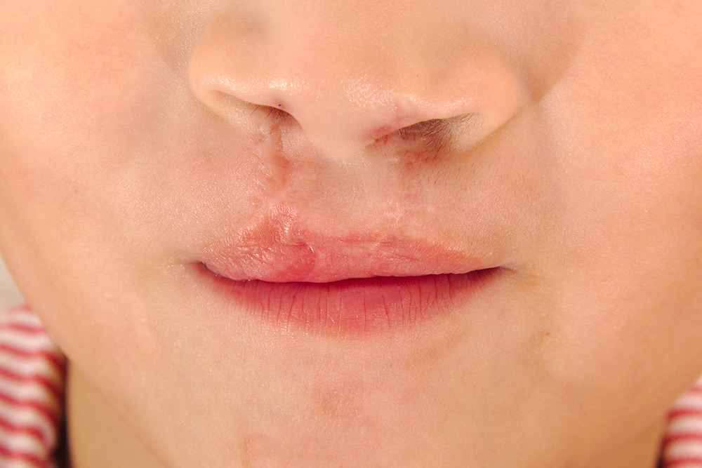 Introduction to Cleft Lips and Palates